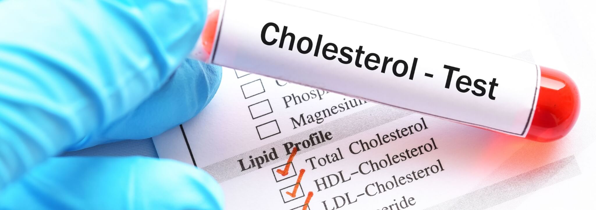 Hoog cholesterolgehalte veroorzaakt geen hartziekten, statines gevaarlijk